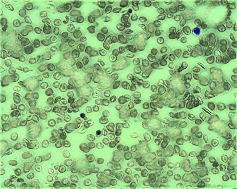Red Cell Indices - MCV, MCH & MCHC | Laboratory Hub