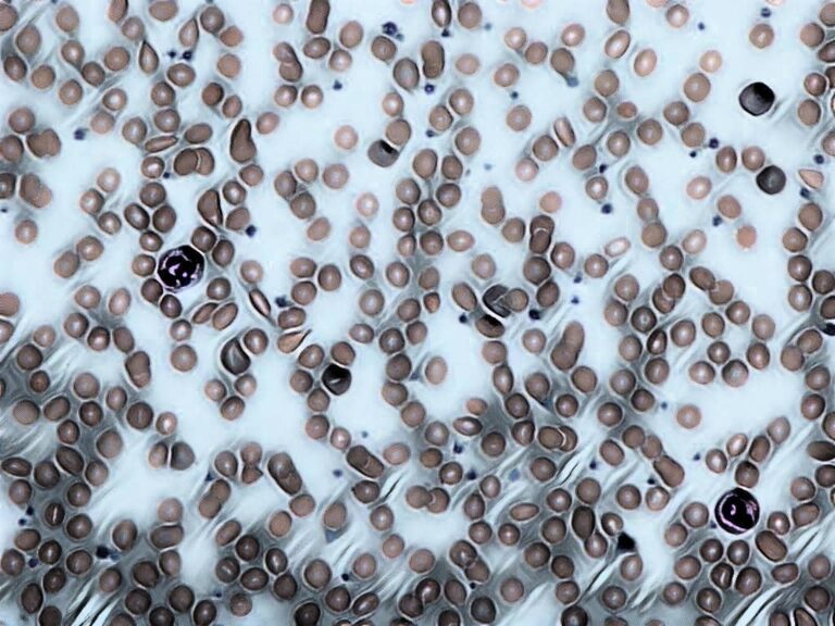 Red Cell Indices - MCV, MCH & MCHC | Laboratory Hub